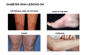 Diabetic Dermopathy, Diabetes Itching Skin Treatment | Sugar Knocker