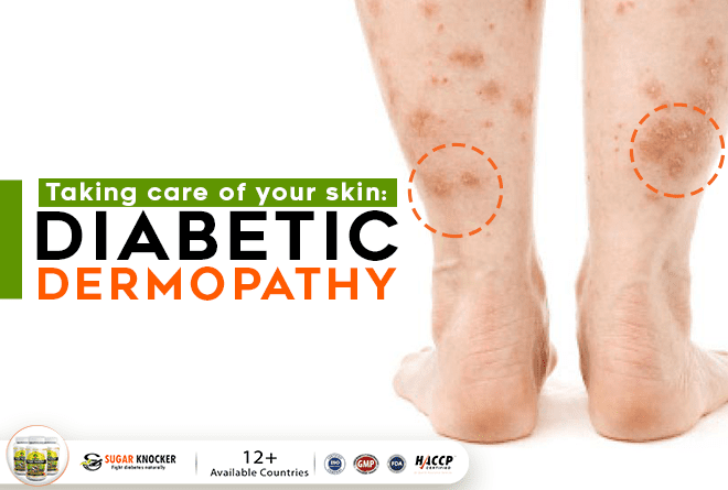 Diabetic Dermopathy, Diabetes Itching Skin Treatment | Sugar Knocker